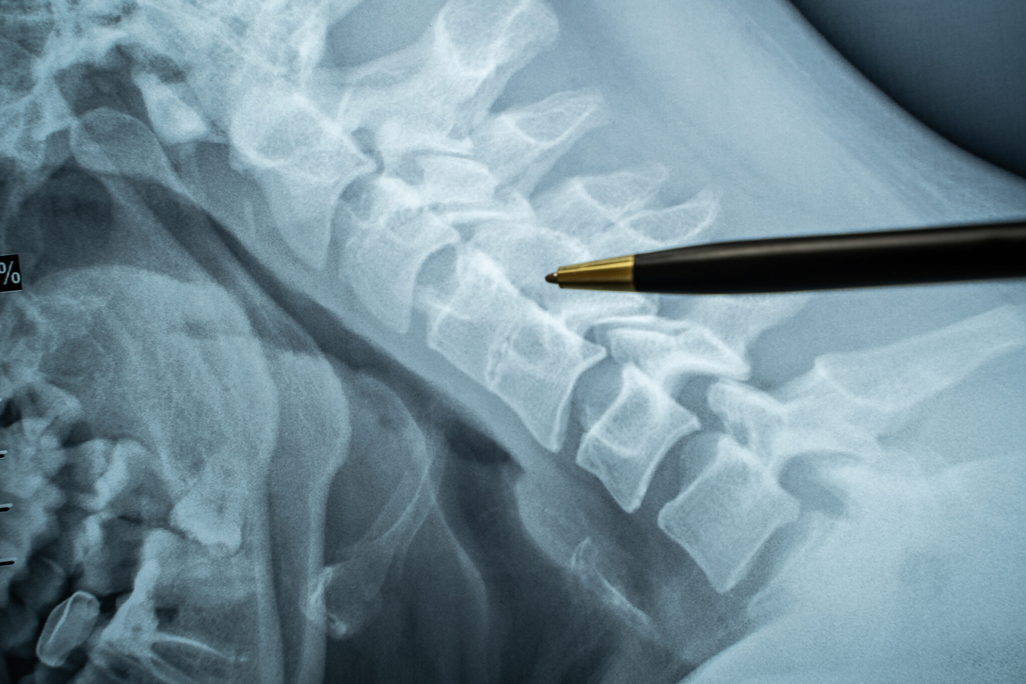 Paravertebral Nerve Block - MISPI | Minimally Invasive Spine and Pain ...